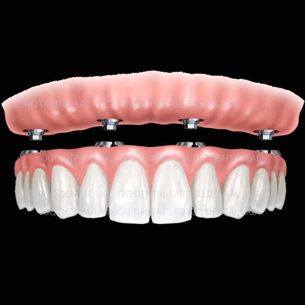 Quality Full Mouth Dental Implant Bridge Customized Implanting Guide For Oral Restoration for sale