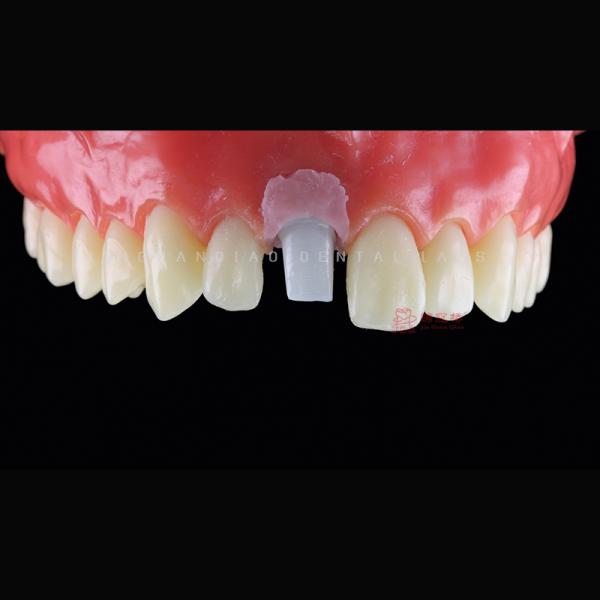 Quality Custom China Dental Lab Milling Service Titanium Zirconia Dental Implants Abutment for sale