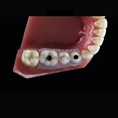 China Endosteal Dental Implants Bridges or Removable Dentures Lab China for sale