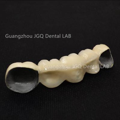 China Digital 3D Printing Pfm Metal Ceramic Crowns and Bridges Aesthetically Pleasing for sale