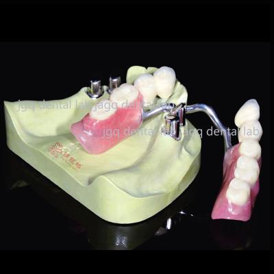 China Telescope Dental Crowns High Precision Milled Precision Attachments With Acrylic Teeth Set Up for sale