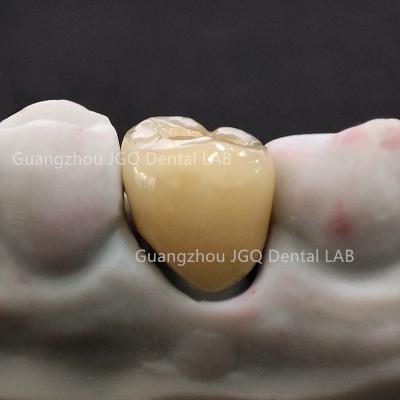 a bridge for teeth