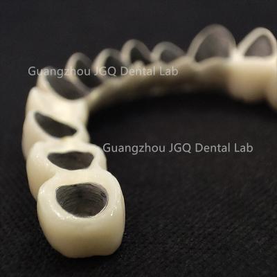 China Durable Fixed Dentures Metal Ceramic Bridge For Dental Restorations for sale