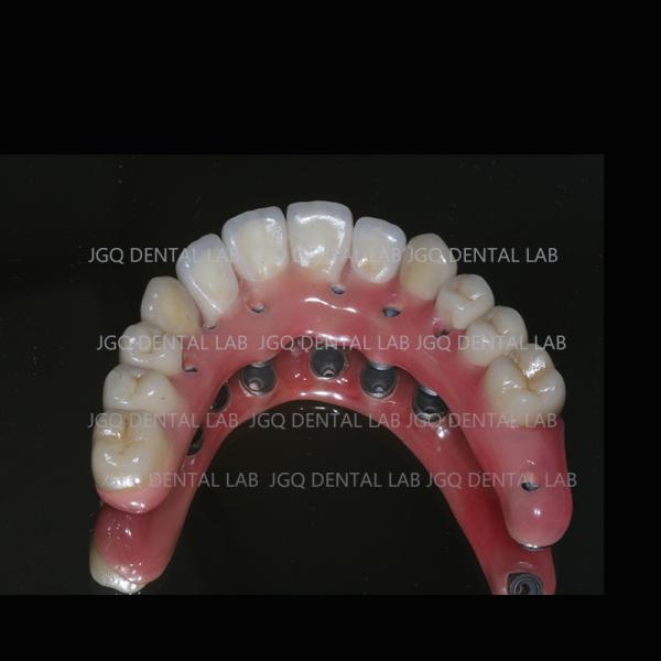 Quality Monolithic Zirconia Crown Full Jaw Implant Bridge Cement Retained Implant Crown and Bridge for sale