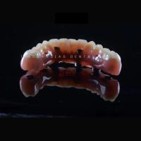 Quality Multi Unit Abutment Titanium Alloy Zirconia Bridge Dental Implant Durable for sale