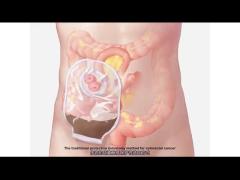 Biodegradable  Intestinal Bypass Stent