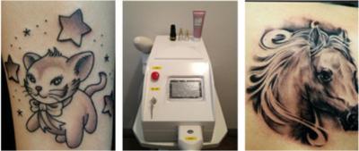 China Mini Q Switch Nd Yag Laser for Removing Tattoo of All Kinds of Color CE Approved for sale
