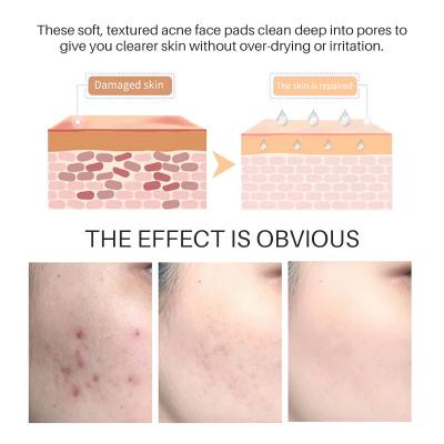 Cina I brufoli di rimozione della cicatrice dell'acne che imbiancano affrontano l'anti crema crema del trattamento dell'acne in vendita