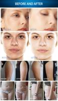 China Noninvasive  Body Slimming Machine For Face Neck Fat Reduction for sale