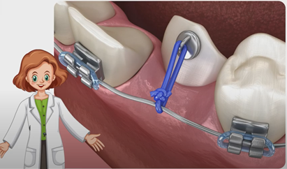 Elastic Thread Solid orthodontic product image