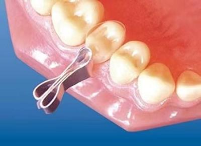 China Class II Dental Kit of Metal Matrices for molars Combined with Clamp Universal Kit TOR VM/ TOP BM PROFESSIONAL DENTAL for sale