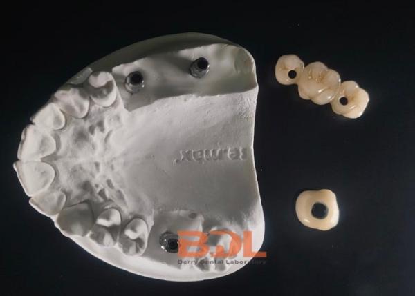 Quality Adaptable Bone Density TypeⅡ-Ⅳ Bone Dental Implant Bar Component For Dental for sale
