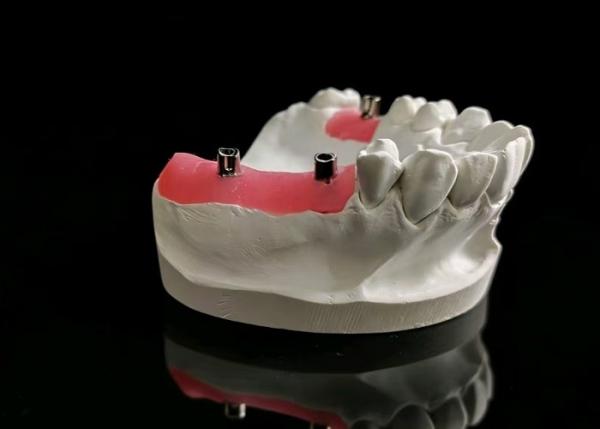 Quality CNC Precision Machining Custom Abutment Dental Implant For Missing One Or More for sale