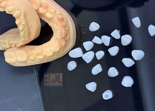 Quality High Translucency Custom Ceramic Veneer With Longevity 10 Plus Years In Dental for sale