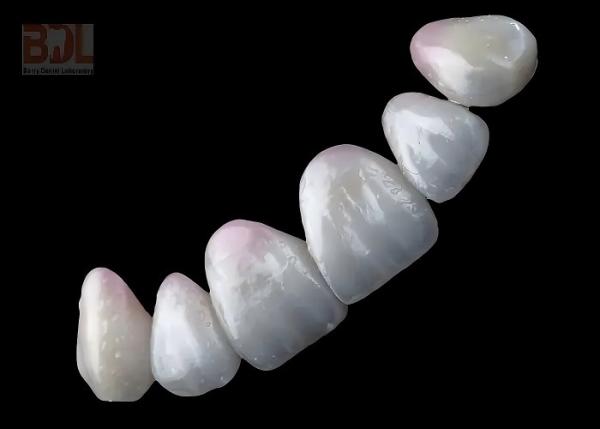 Quality High Translucency Custom Ceramic Veneer With Longevity 10 Plus Years In Dental for sale
