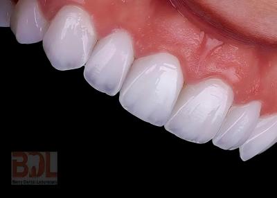 China Flexural Strength 400MPa IPS Emax Veneer with 16 Shade Dentin Enamel Scale and High Translucency for sale