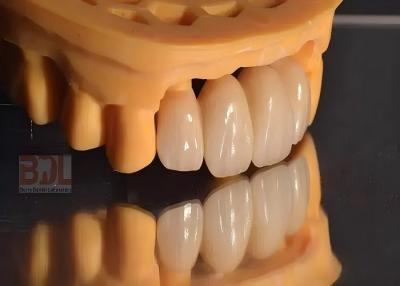 China Wear Resistance Porcelain Fused To Metal With Good Biocompatibility Natural Tooth Appearance for sale