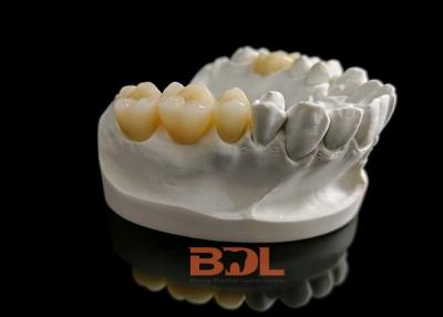 China Porcelain Fused To Metal Dental Restoration With Strong Metal Ceramic Bond Natural Tooth for sale