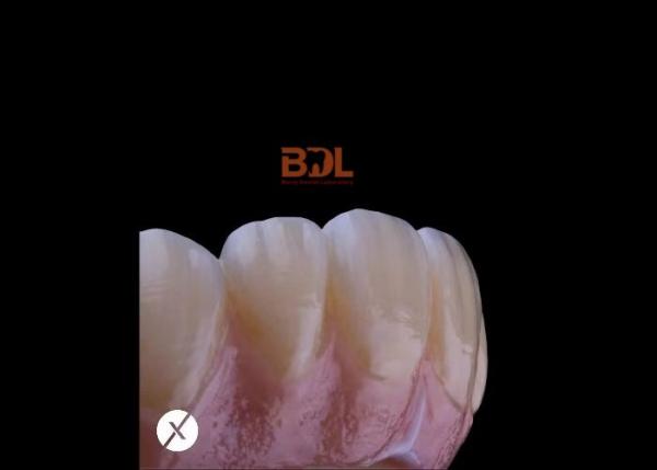 Quality Full Zirconia Ceramic Dentures High Precision Digital Production For Functional Restoration for sale