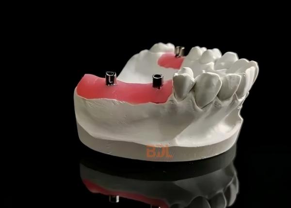 Quality Adaptable Bone Density TypeⅡ-Ⅳ Bone Dental Implant Bar Component For Dental for sale