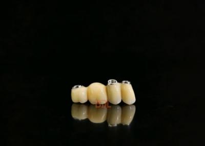 China Dental Implant Bar screw retained implant bridge multi unit fixed restoration for patients with multiple consecutive missing teeth for sale