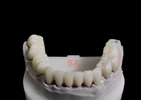 Quality Ceramic Dentures High Strength and Durable Customized All Ceramic Dental Bridge with Anatomical Accuracy and Custom Shade Matching for sale
