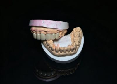 China Custom Porcelain Fused To Metal Crown Engineered To Deliver Optimal Strength And Aesthetic Appeal For Dental Prosthetics for sale