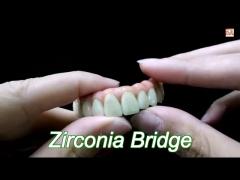 maloney zirconia bridge implant bar for dental restoration custom no foreign body sensation