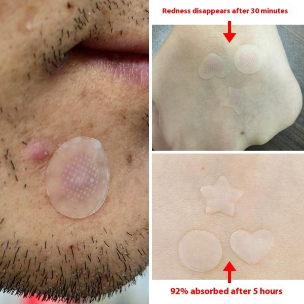 Quality Single Sided Painless Microneedle Acne Patch Microcrystals Water Activated PE for sale