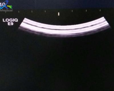 China Substituição convexa vívida da lente do reparo da ponta de prova do ultrassom da disposição de GE E90 C1-6-D à venda