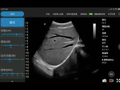 Electronic Convex Array Wireless Ultrasound Device For Mobile Phone