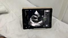 Dual Head Wireless Ultrasound Probe for Cardiac and POCUS