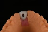 China Roughened Surface Titanium Dental Implants Surgery For Front Tooth Replacement for sale