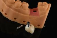 China Precision Cylindrical Silver Single Tooth Replacement Implants Dental Restoration for sale