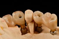 China Self Tapping 3.0mm Thread Dental Titanium Implant Optimized Functionality for sale