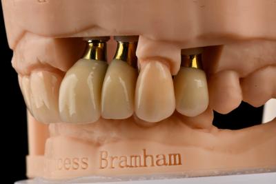 Chine Implant de remplacement de dent unique au sable de titane avec stérilisation par rayonnement gamma à vendre