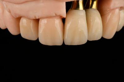 Chine Implant de remplacement de dent unique au sable de titane avec stérilisation par rayonnement gamma à vendre