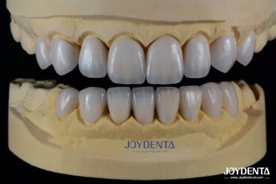 China Las carillas de porcelana cerámica avanzada de sombra biocompatible combinada para una sonrisa natural for sale