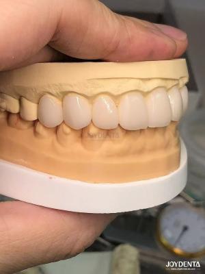 Cina Sfumature personalizzate per abbinare i denti naturali Biocompatibili e resistenti alle macchie Finiture dentali in vendita
