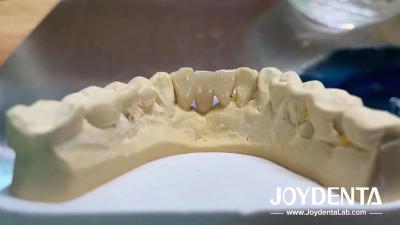 China Customizable Dental Maryland Resin Bonded Bridges for Anterior And Premolar Teeth for sale