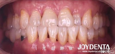 China Customizable Dental Maryland Resin Bonded Bridges for Anterior And Premolar Teeth for sale
