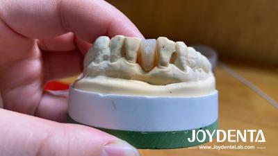 China Customizable Dental Maryland Resin Bonded Bridges for Anterior And Premolar Teeth for sale