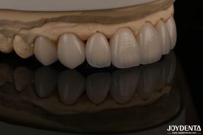 China Feldspathic Natural Looking Cosmetic Veneers Precise Fit Highly Translucent for sale