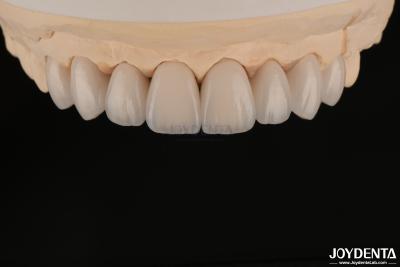 China Feldspathic Natural Looking Cosmetic Veneers Precise Fit Highly Translucent for sale