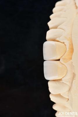 Cina Dental Fieldspathic Veneer di lunga durata Colore naturale dei denti Aspetto trasparente in vendita