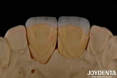 Cina Dental Fieldspathic Veneer di lunga durata Colore naturale dei denti Aspetto trasparente in vendita