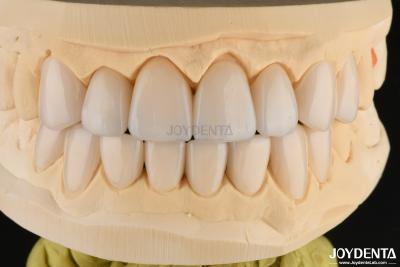 Cina 0.3-0.5mm di spessore Feldspathic Porcellana Veneer Alta resistenza alle fratture Aggiornare il tuo sorriso in vendita
