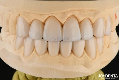 Cina 0.3-0.5mm di spessore Feldspathic Porcellana Veneer Alta resistenza alle fratture Aggiornare il tuo sorriso in vendita