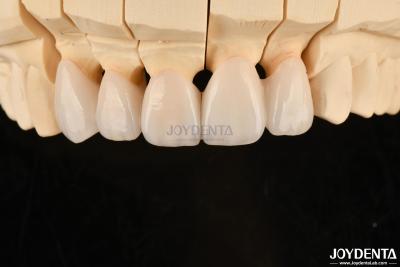 China Zeer aanpasbare gelaagde circonia tandkronen en bruggen Langdurige oplossing Te koop