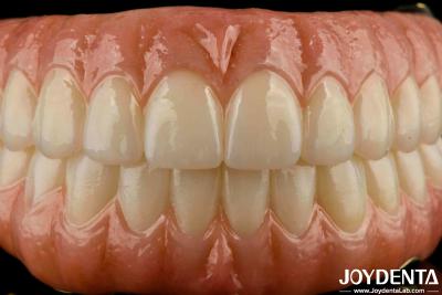 Cina Precise Fit Dental Ti-Bar Zirconia Hybrid Bridge Replacement per i denti mancanti in vendita
